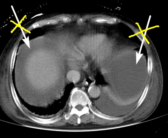 如何引流雙側 subphrenic abscesses？ | 蔡依橙