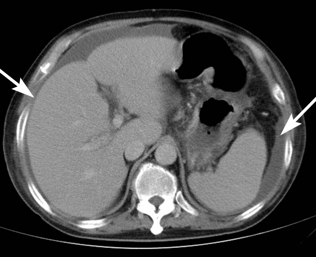 如何引流雙側 subphrenic abscesses？ | 蔡依橙