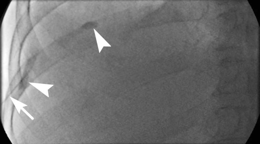 如何引流雙側 subphrenic abscesses？ | 蔡依橙