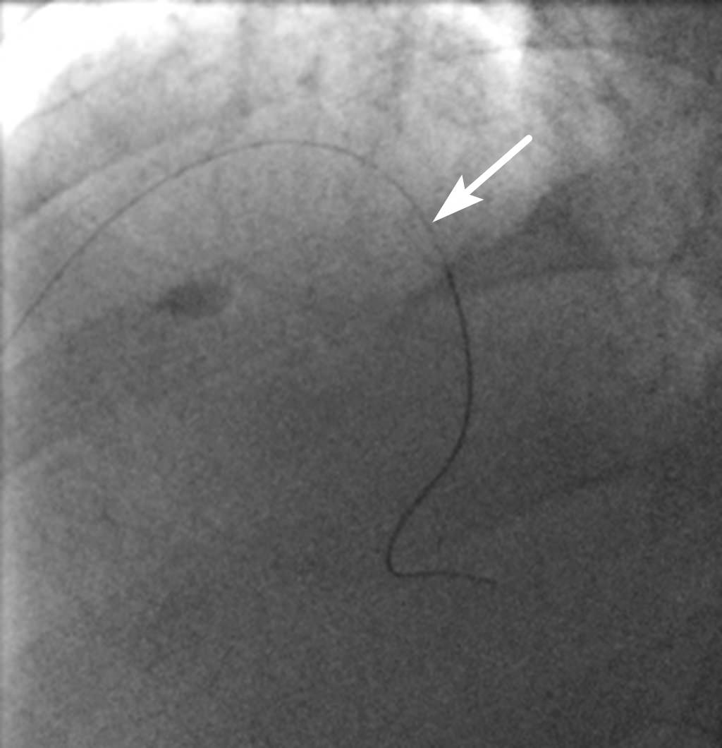如何引流雙側 subphrenic abscesses？ | 蔡依橙