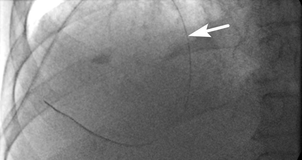 如何引流雙側 subphrenic abscesses？ | 蔡依橙