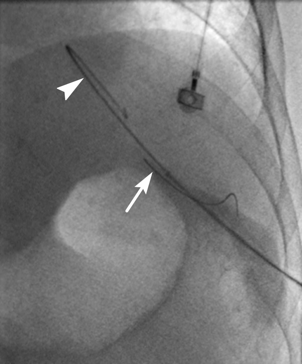 如何引流雙側 subphrenic abscesses？ | 蔡依橙